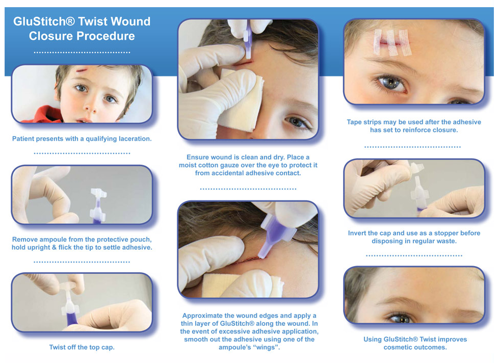 GluStitch® Twist